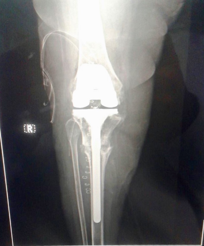 Best Knee Replacement Surgeon in Hyderabad